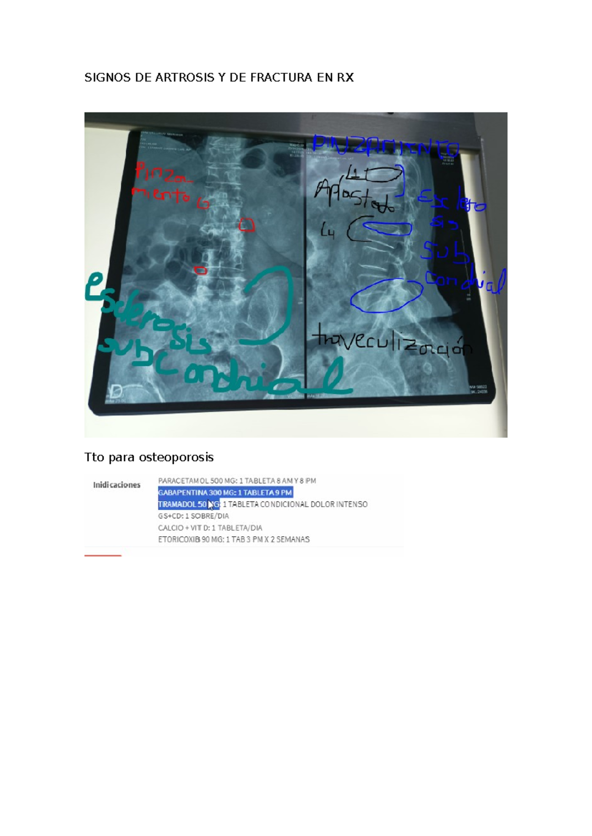Signos DE Artrosis Y DE Fractura EN RX - Medicina - SIGNOS DE ARTROSIS ...