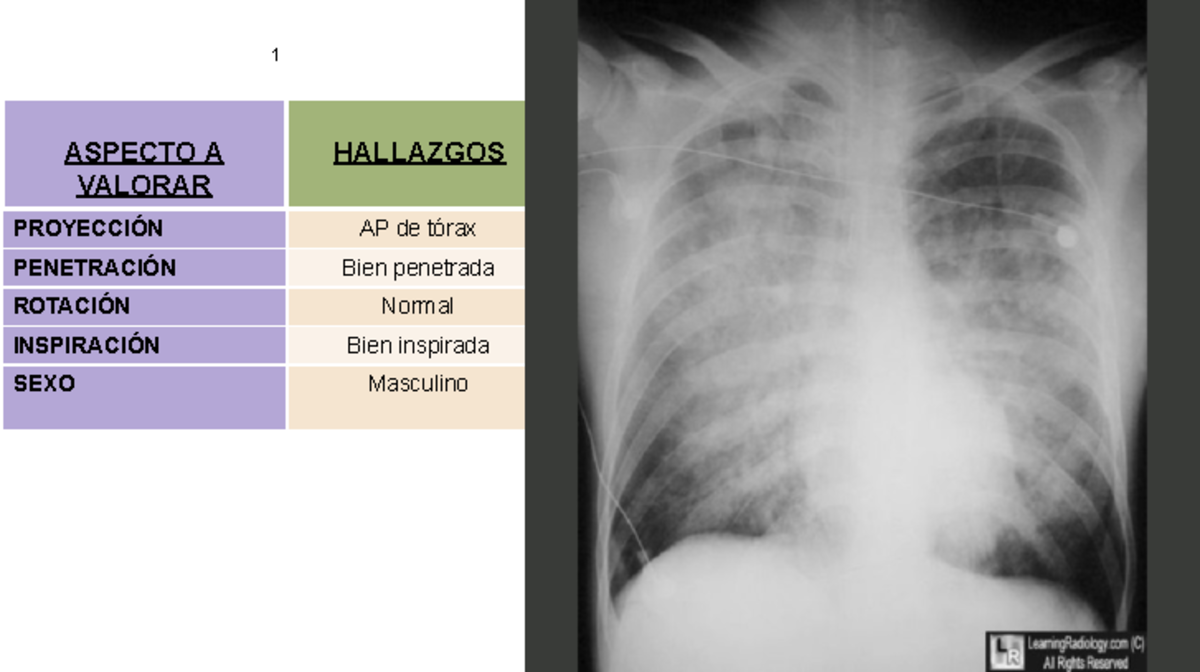 Tarea de Radiografía - ASPECTO A VALORAR HALLAZGOS PROYECCIÓN AP de ...