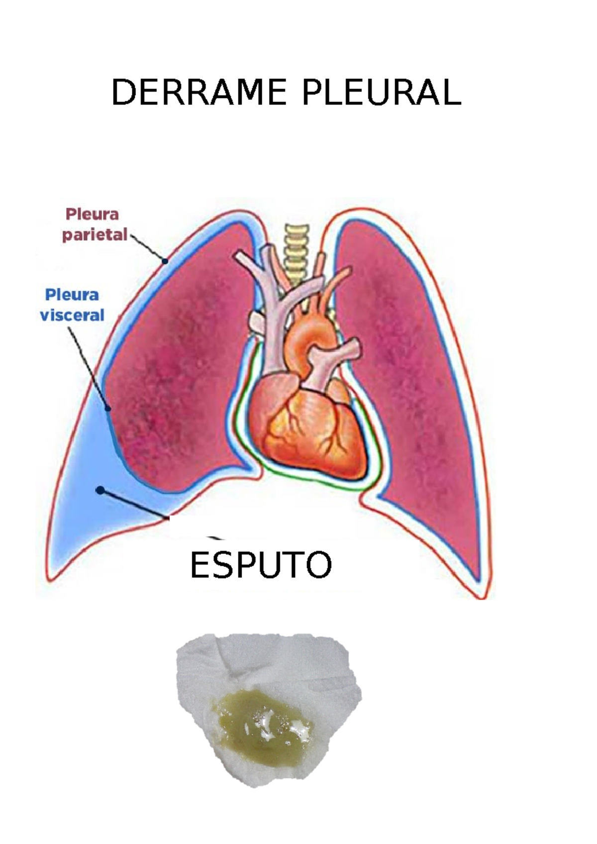 Esputo Y Derrame Pleural - DERRAME PLEURAL ESPUTO ESTUDIANTES DE IV - D ...
