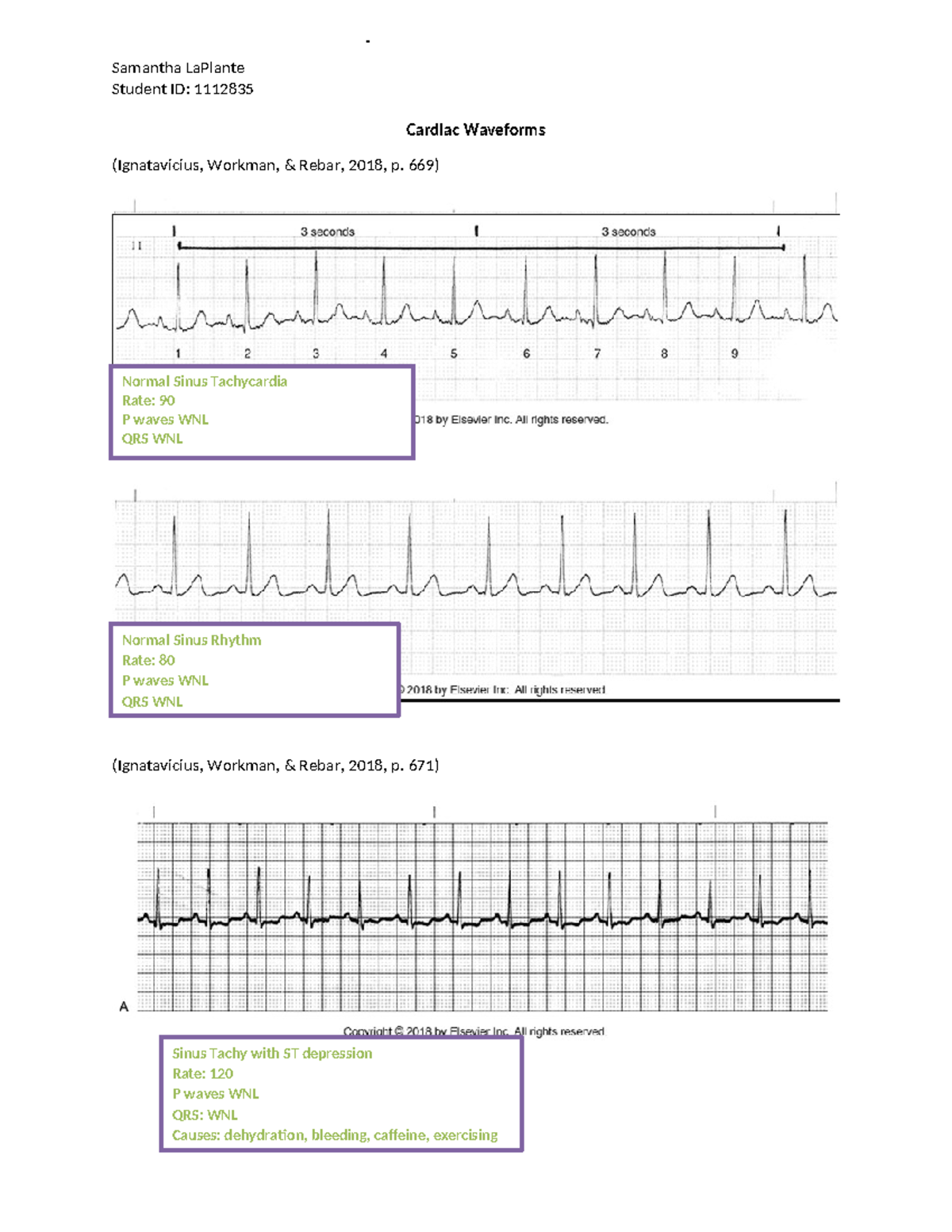 NUR 242 Unit 9 - EKG strip & Nclex - Student ID: 1112835 Cardiac ...