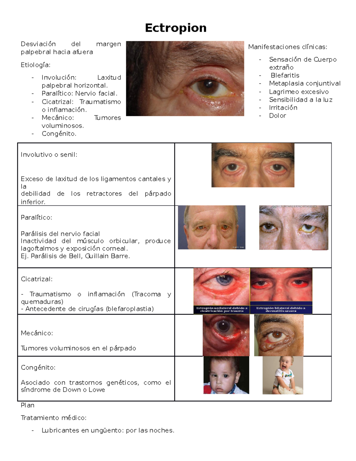 Entopión, Ectropión, Dacriocistitis - Ectropion Desviación del margen ...