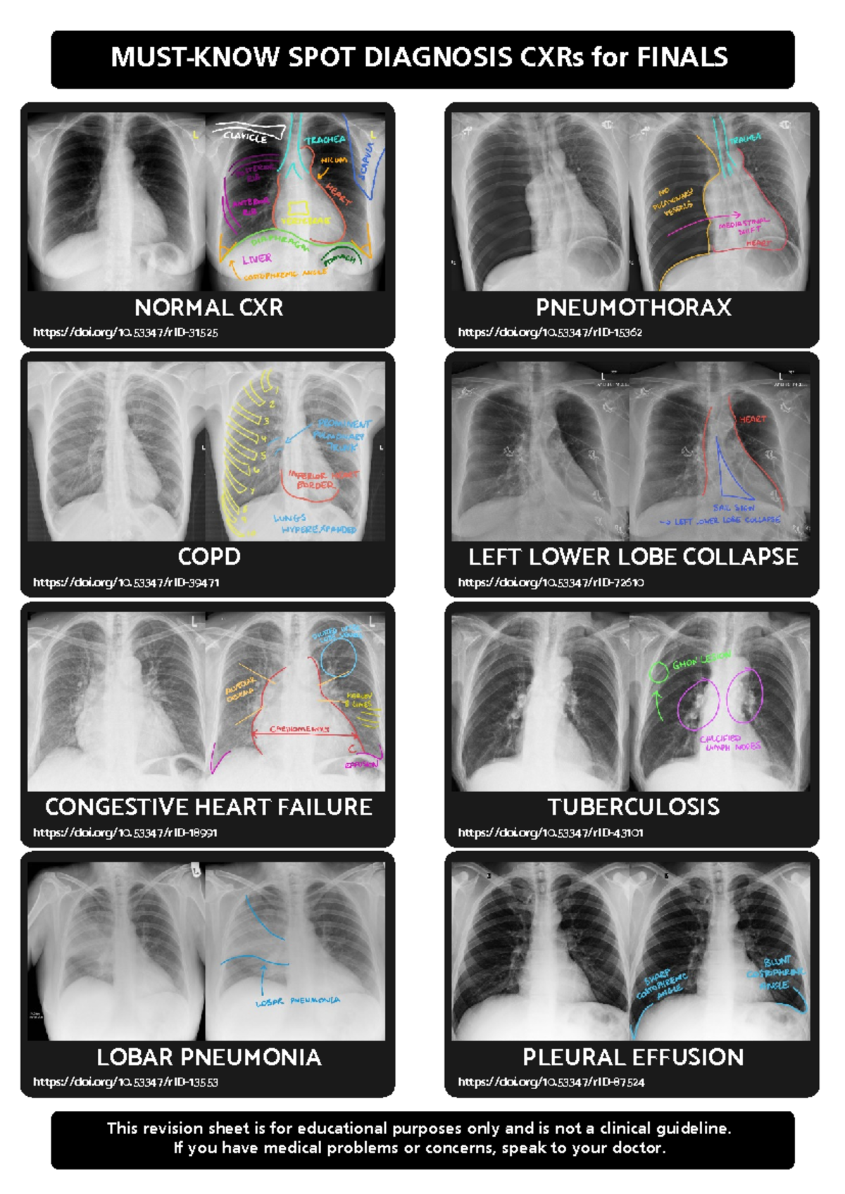 CXR Key Signs - NORMAL CXR This revision sheet is for educational ...