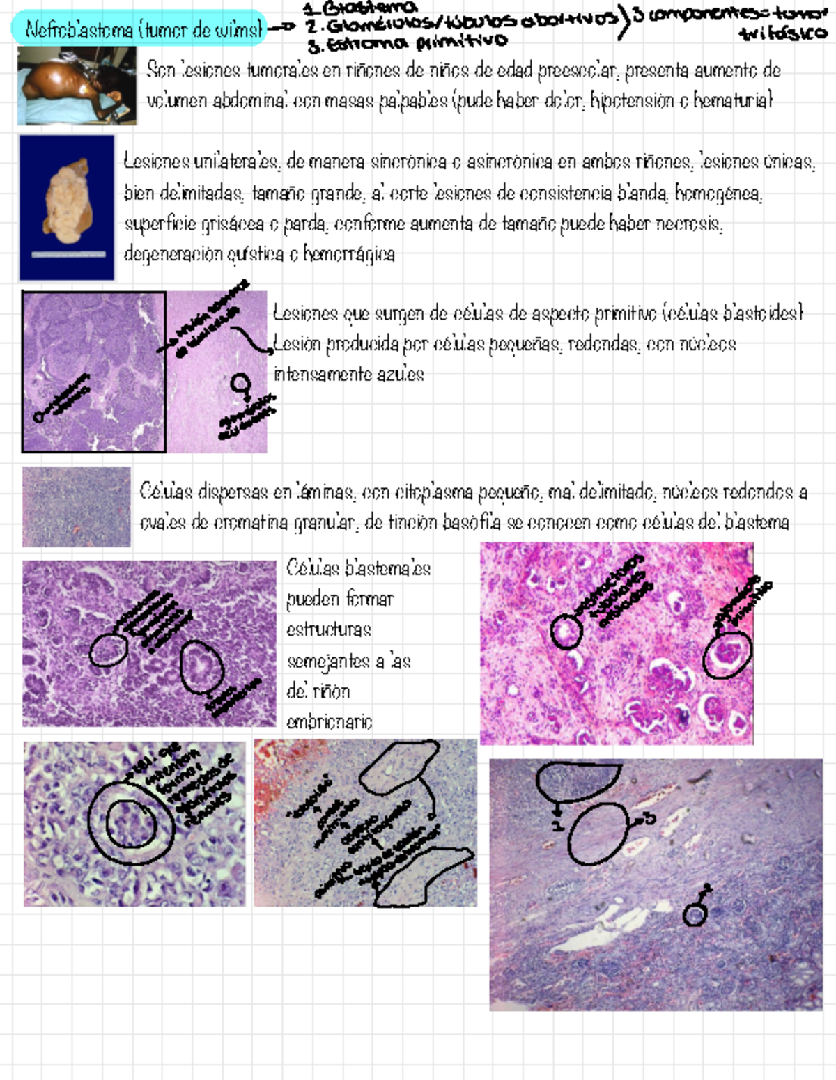 Patología laboratorio - Nefroblastoma (tumor de wilms) Son lesiones ...