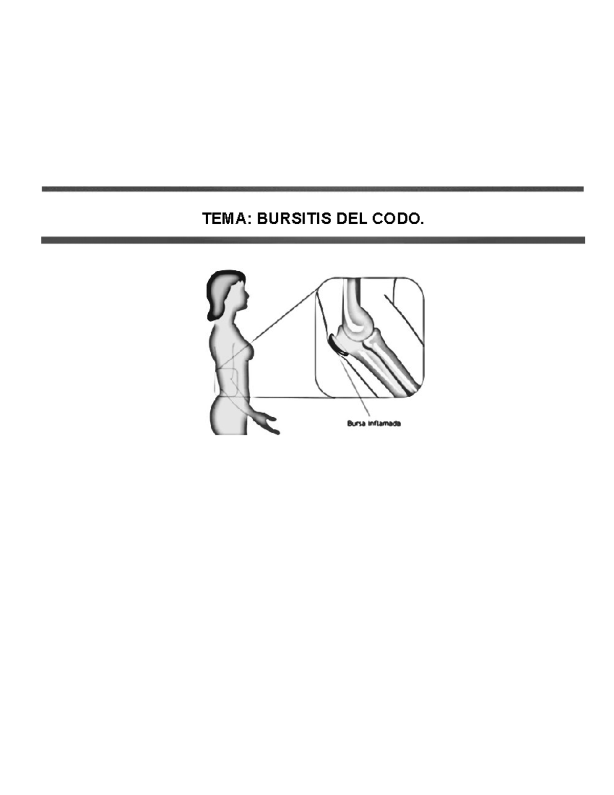 Bursitis DEL CODO - TEMA: BURSITIS DEL CODO. Bursitis del codo ...