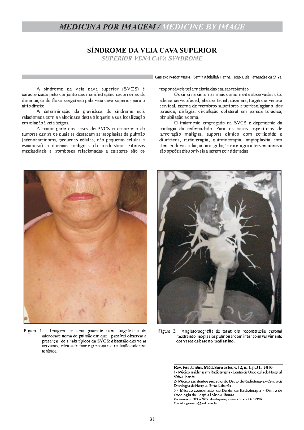 Síndrome Veia Cava Cirurgia Completo Síndrome Da Veia Cava Superior