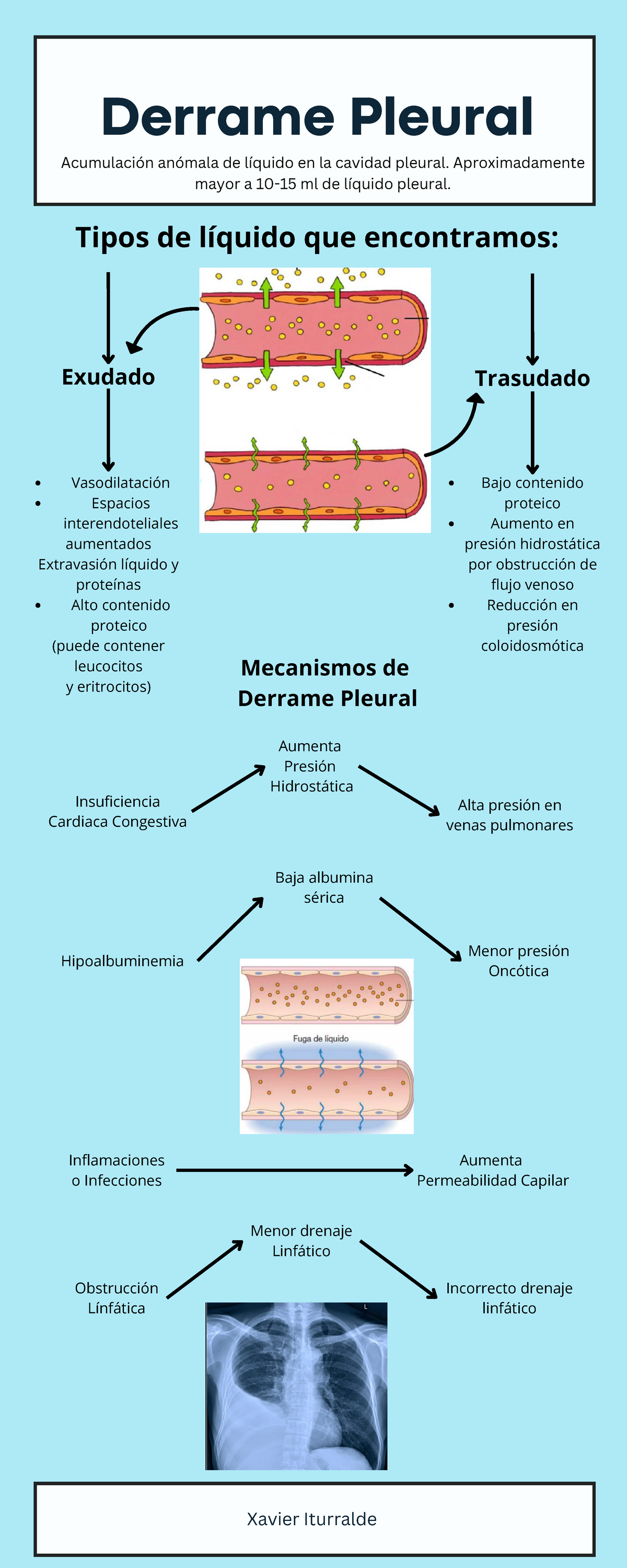 Derrame Pleural - Exudado Trasudado Insuficiencia Cardiaca Congestiva ...