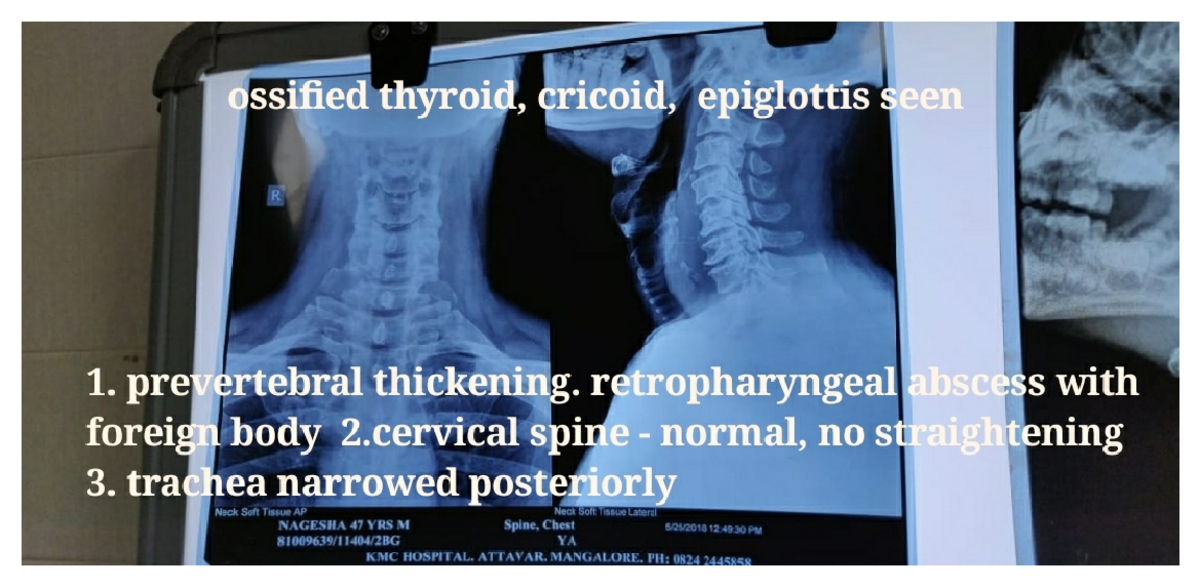 ENT X - Rays - Xrays ent - ossified thyroid, cricoid, epiglottis seen 1 ...