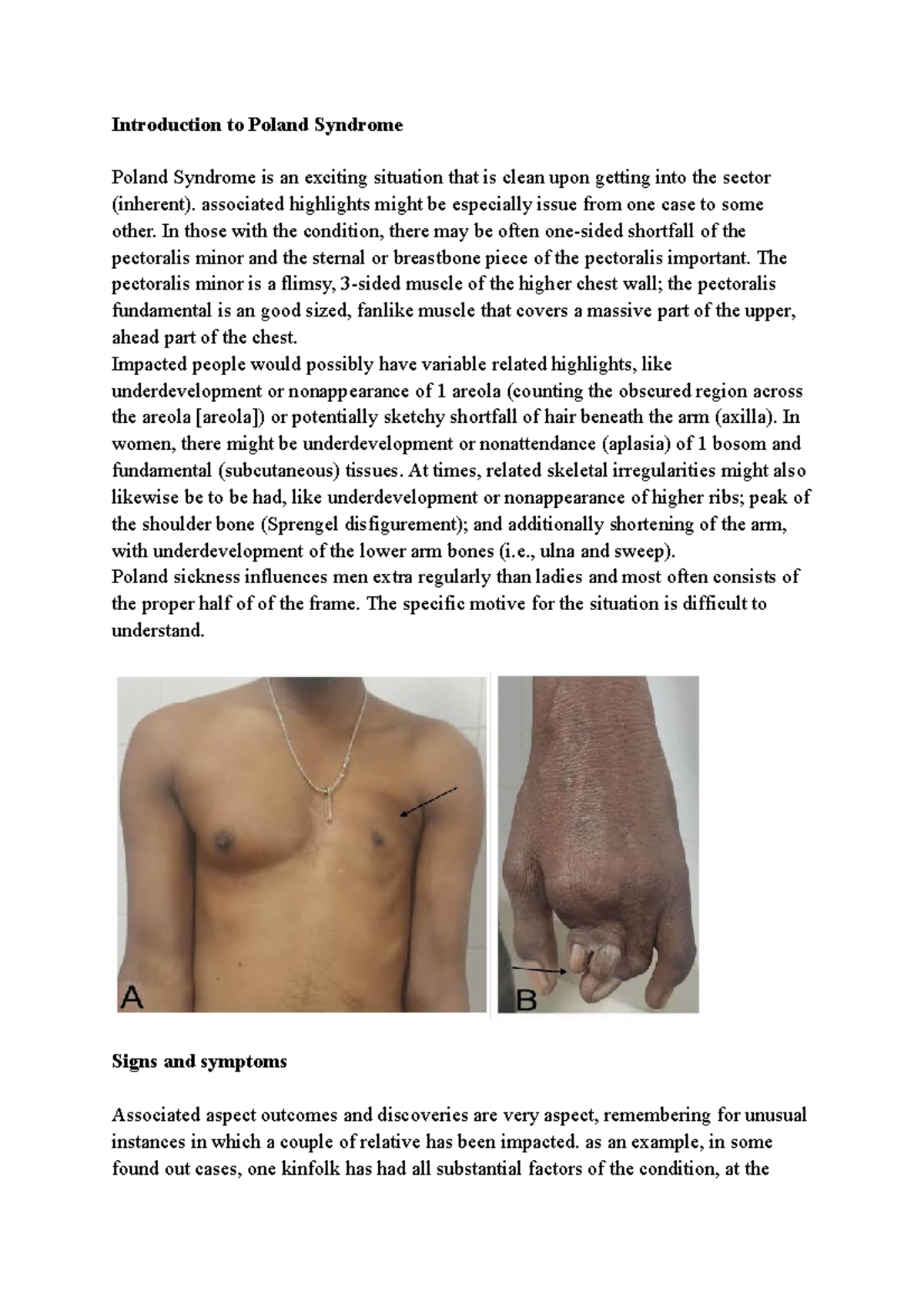 Introduction to Poland Syndrome - Introduction to Poland Syndrome ...