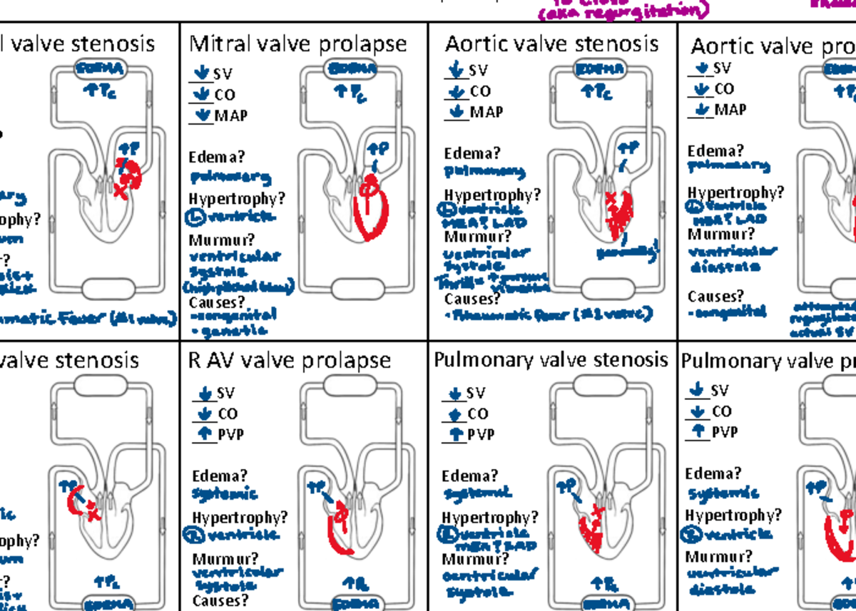 CV+ Disorders+-+Worksheet+-+KEY - Mitral valve prolapse ___SV ___CO ...