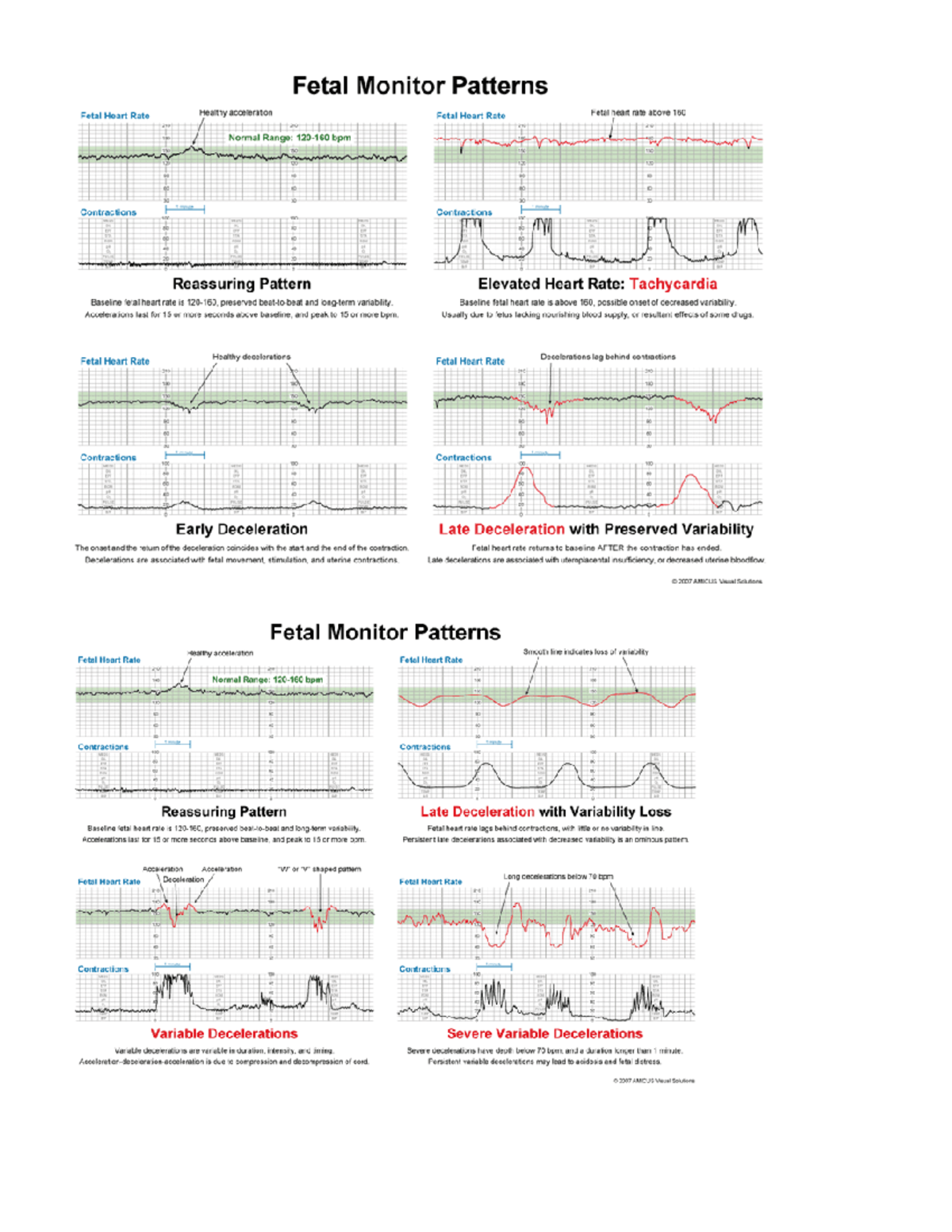 Fetal monitor ex - examples - Fetal Monitor Patterns Fetal Heart Rate ...