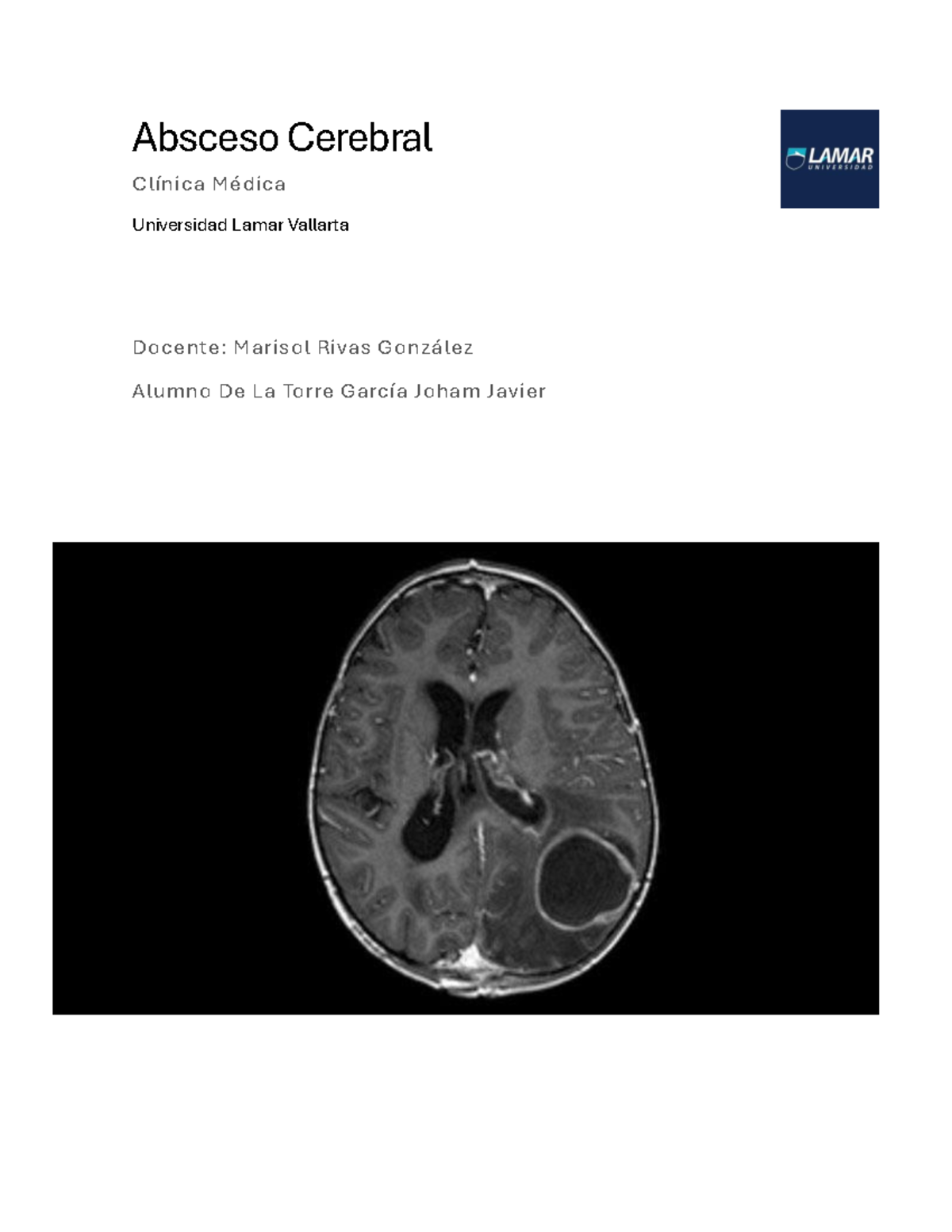 Absceso Cerebral - Absceso Cerebral Clínica Médica Universidad Lamar ...