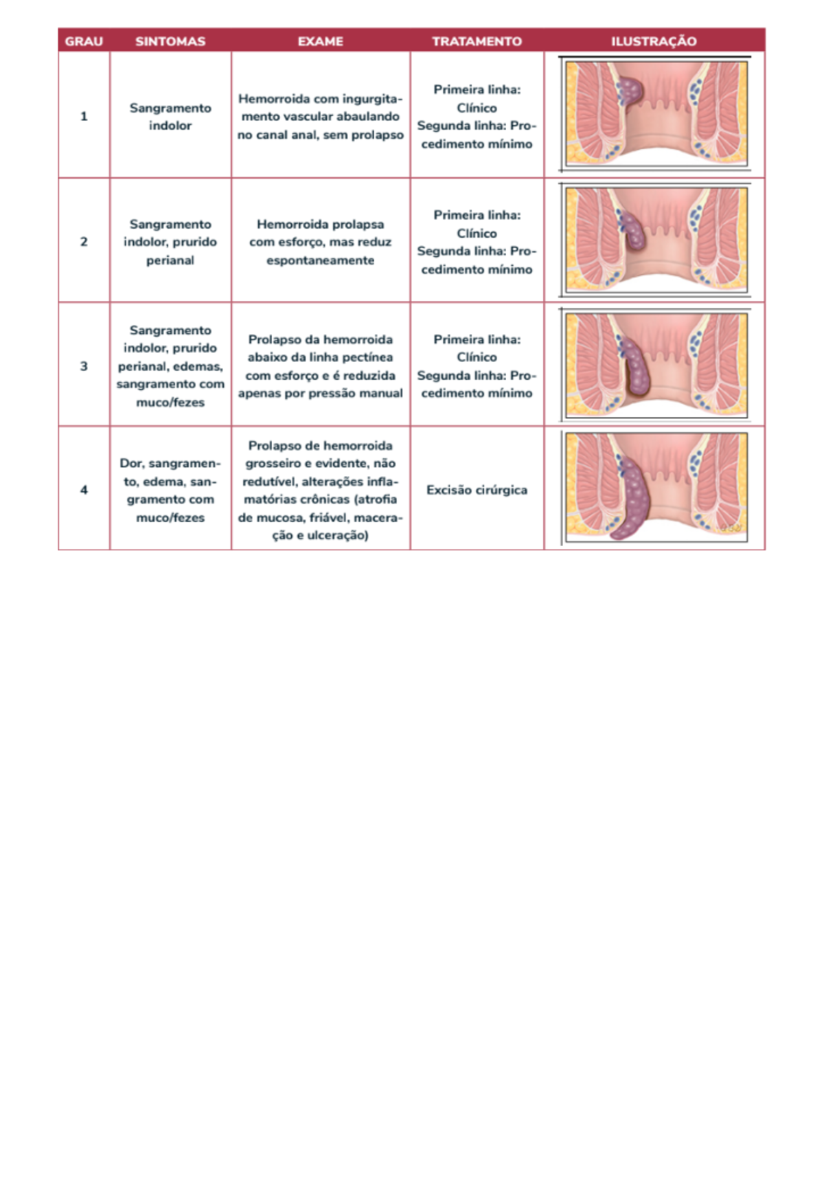 8 Imagem - tabela de hemorroida - Anatomia - - Studocu