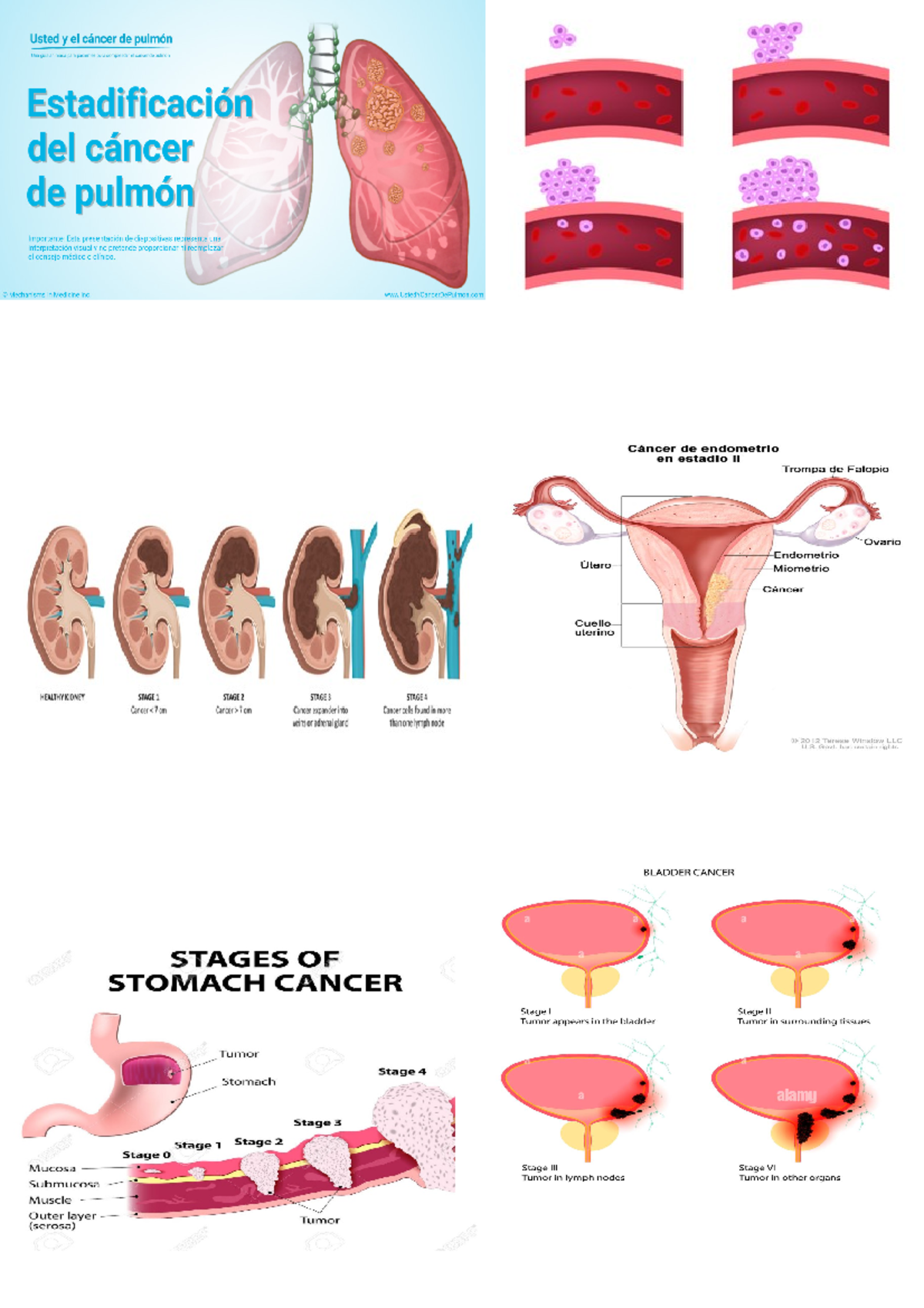 Estadios de cancer - jlkjl - salud comunitaria - Studocu