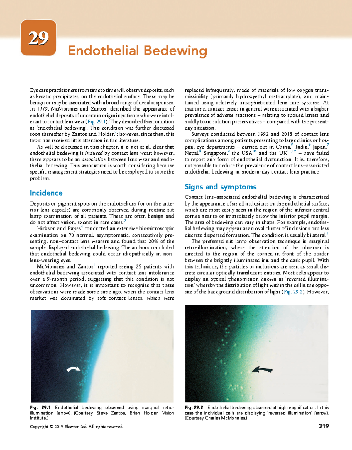 Endothelial Bedewing Contact Lens Complications - 2929 Endothelial ...