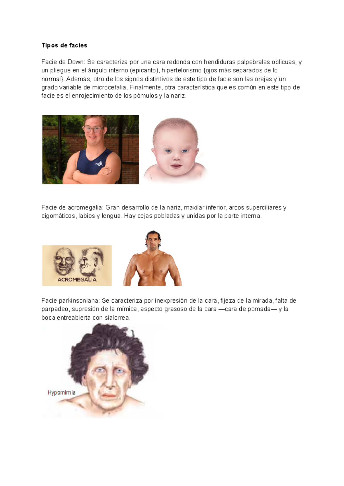 Tipos de facies - Tipos de facies Facie de Down: Se caracteriza por una ...