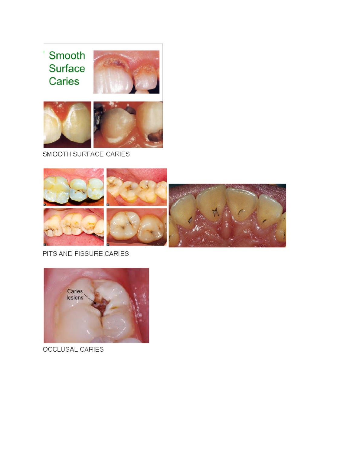 Caries Clinical Cases - notes - Dentistry - SMOOTH SURFACE CARIES PITS ...