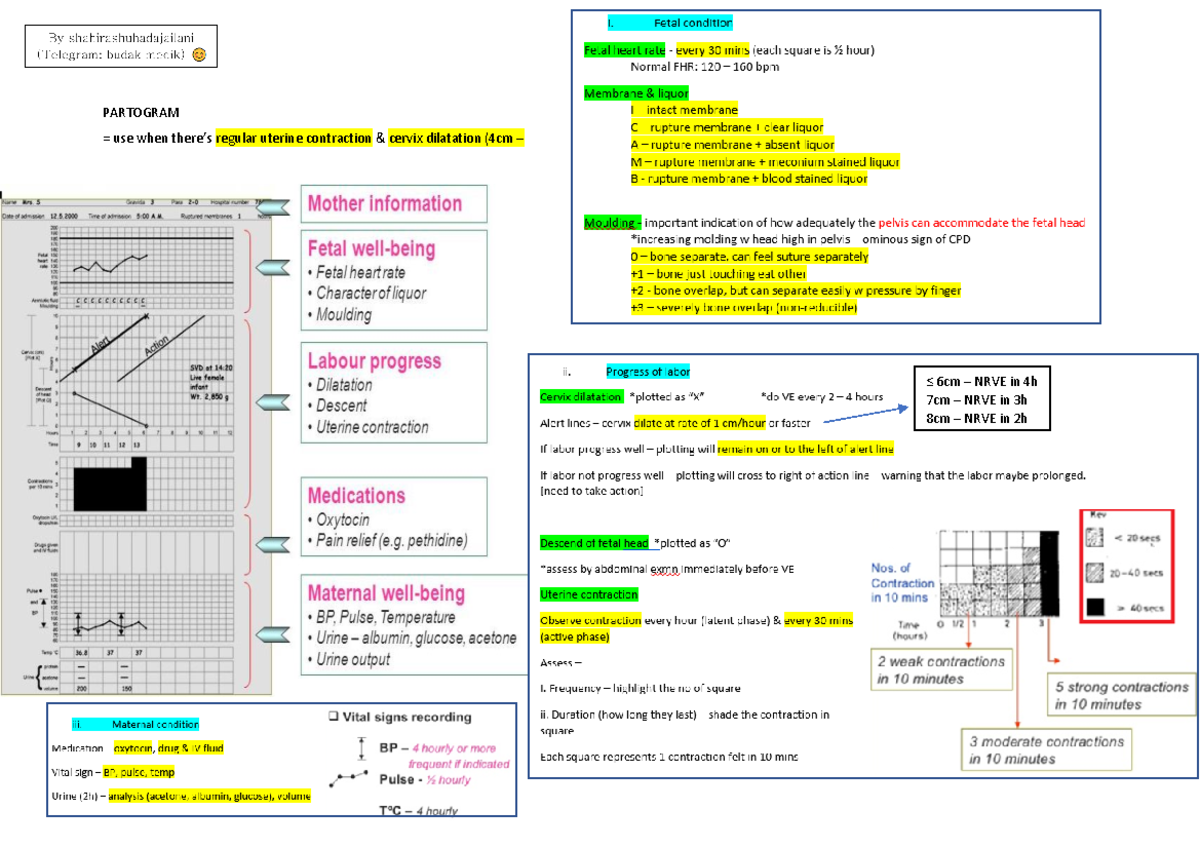 Obs - Partogram - PARTOGRAM = use when there’s regular uterine ...