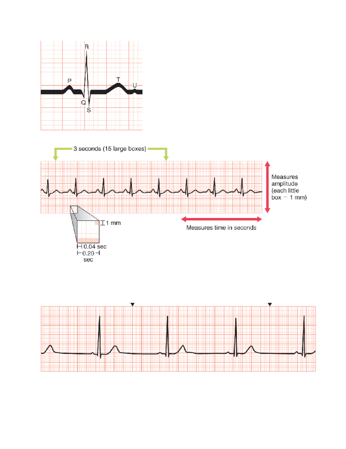 ECG - ECG print out... these pictures are from the book, just look them ...
