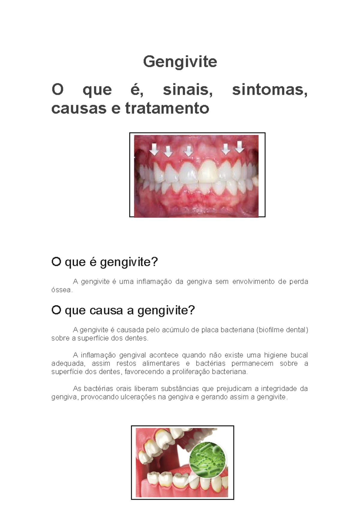 Gengivite - Gengivite O que é, sinais, sintomas, causas e tratamento O ...
