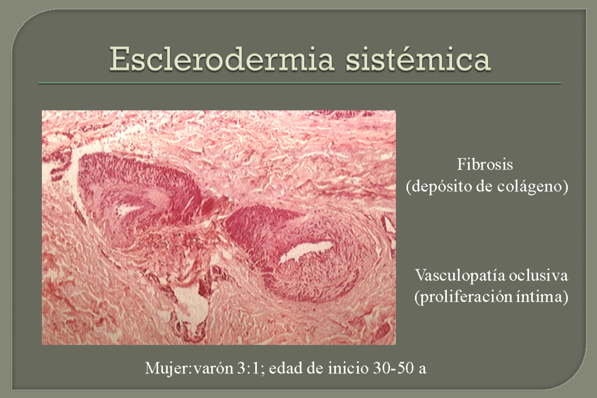 Esclerodermia 2018-19 - Fibrosis (depósito de colágeno) Vasculopatía ...