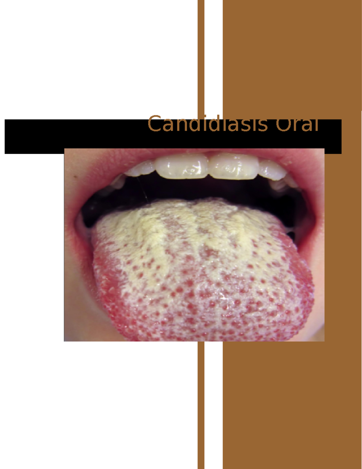 592400201-Candidiasis-Oral - Candidiasis Oral Introducción La ...