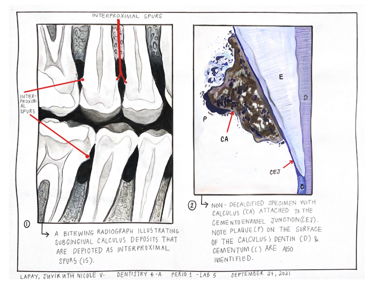 Perio 1-Lab5-Role Of Calculus And Other Local Predisposing Factors ...