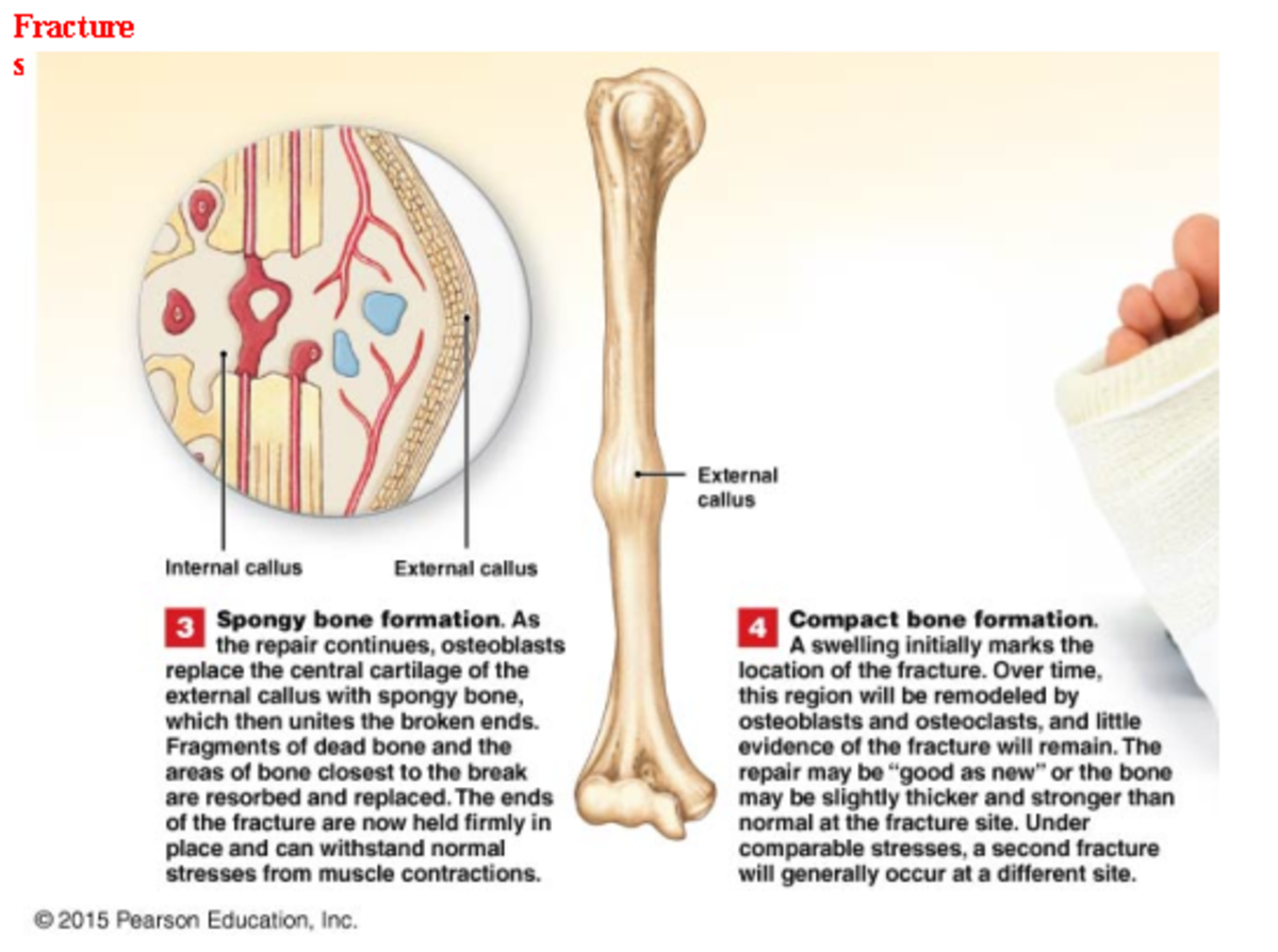 Fracture Repair steps 3-4 - PLN 103 - Fracture s - Studocu