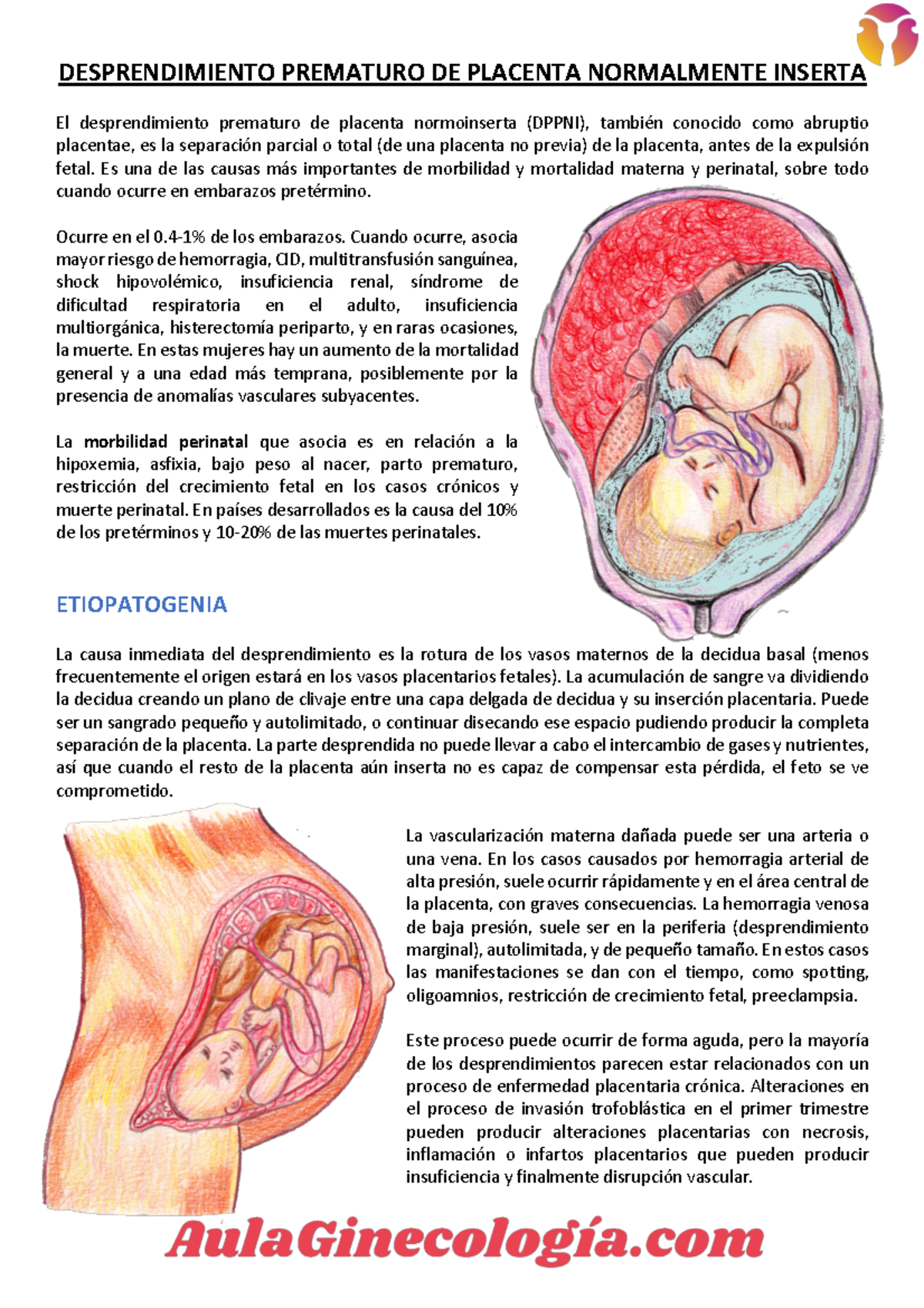 Desprendimiento Prematuro DE Placenta Normalmente Inserta 2 ...