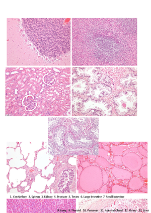 Beer Potomania Article - Severe Hyponatremia in a Schizophrenic Patient ...