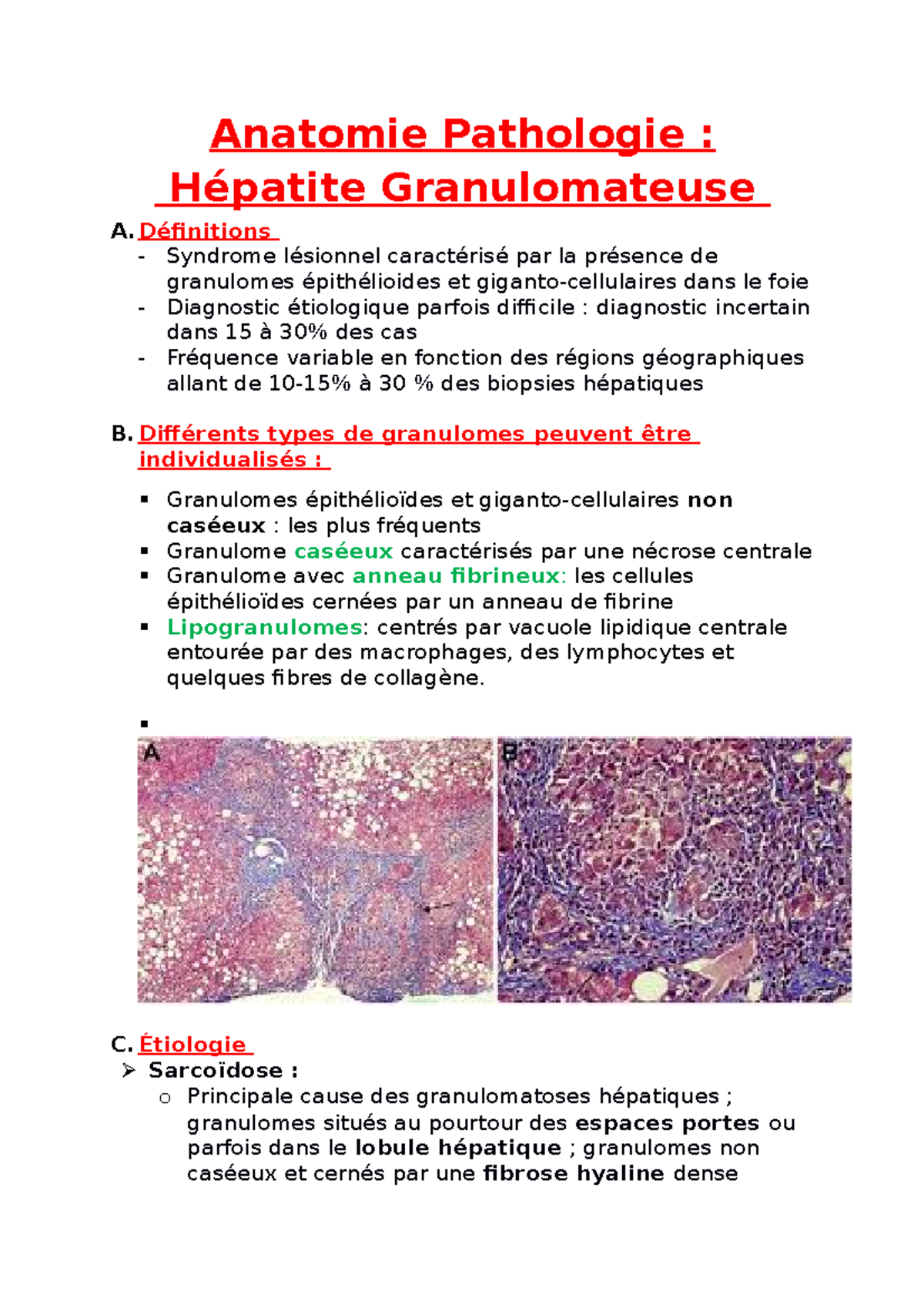Anatomie Pathologie hépatite granulomateuse - Définitions - Syndrome ...