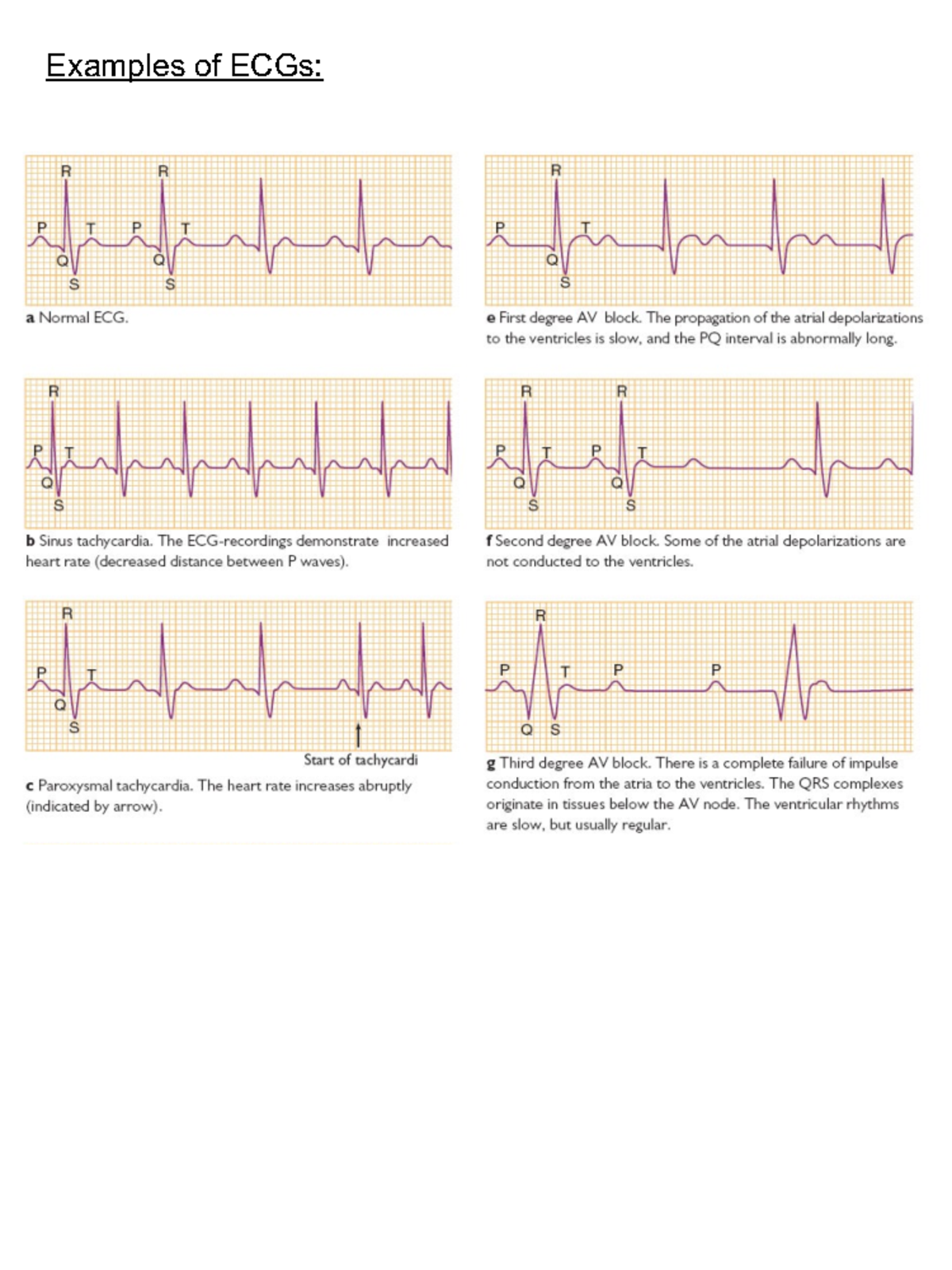 Examples of ECG - e First degree AV block. The propagation of the ...