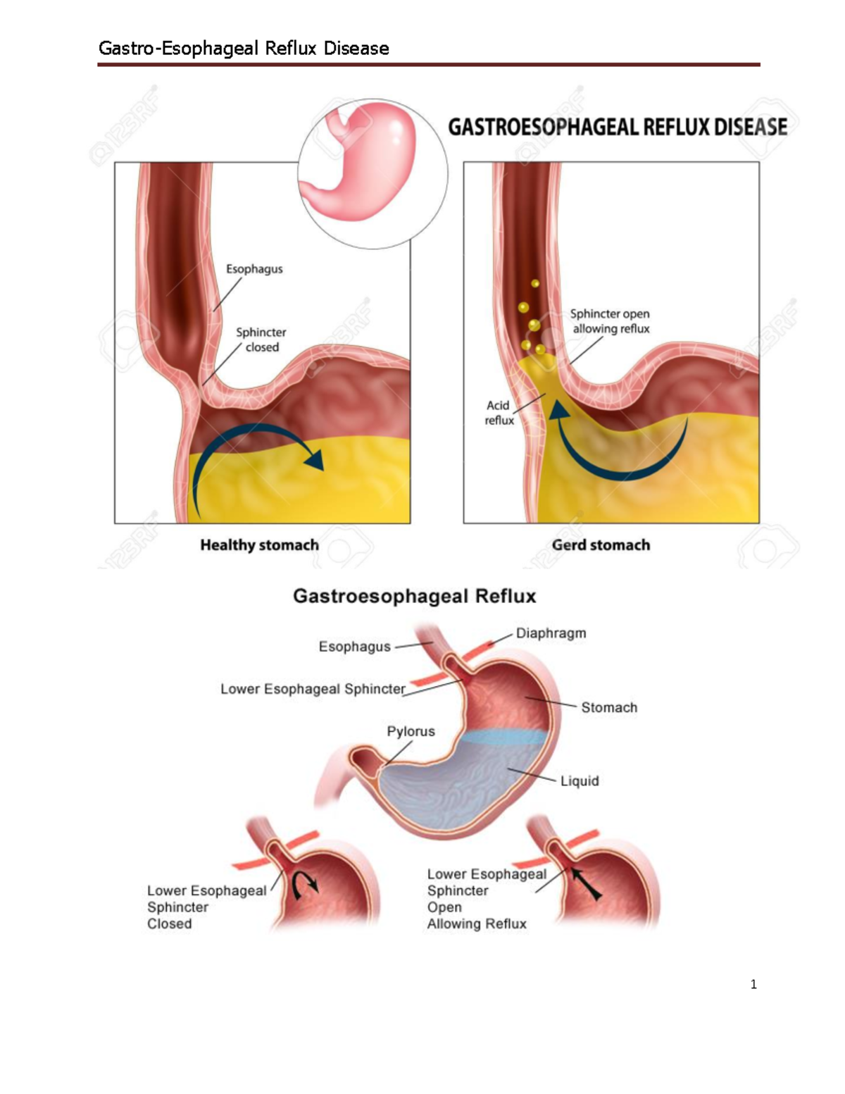 GERD GIT surgery - 4- The mucosal rosette at the cardio-esophageal ...