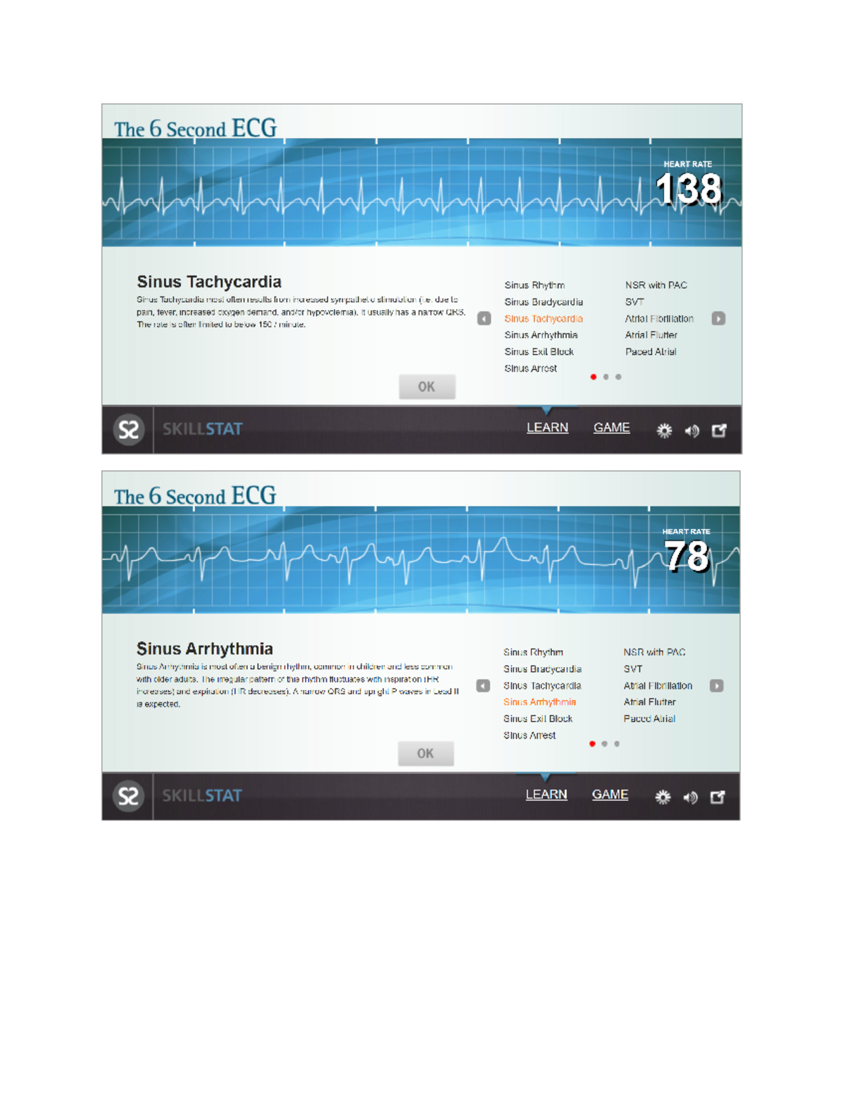 Rythm HR Strips - notes - The 6 Second ECG HEART RATE Sinus Tachycardia ...