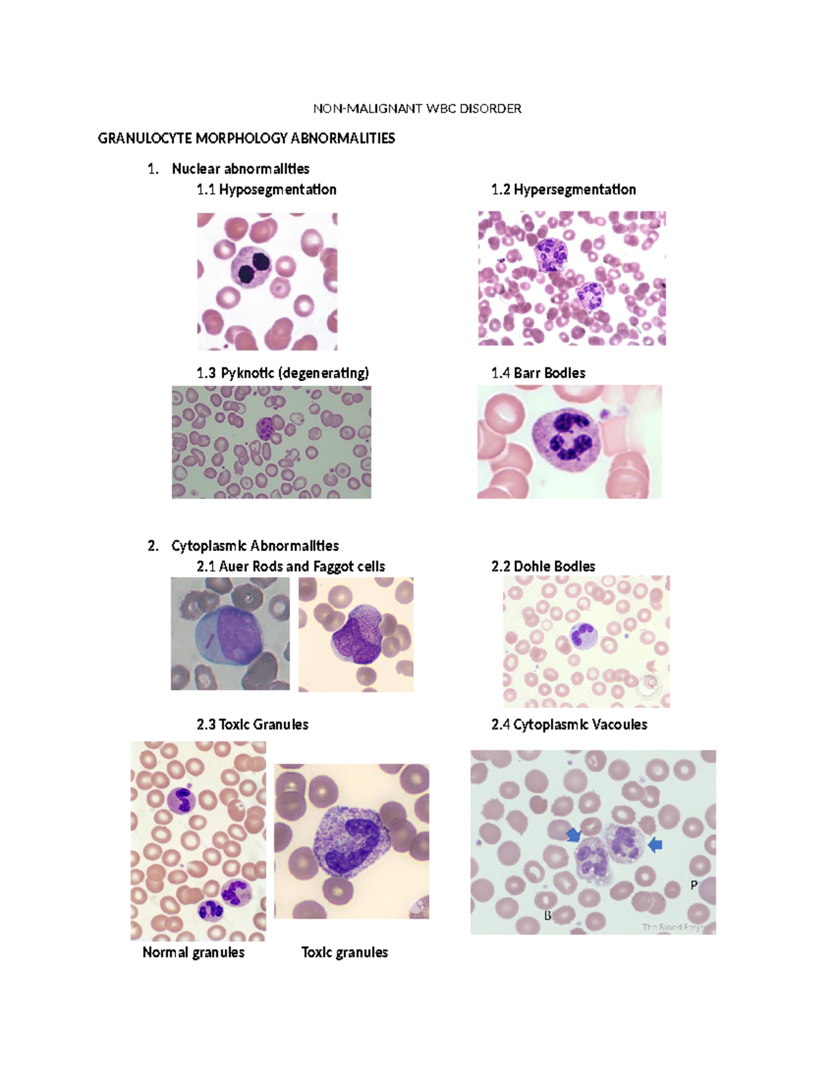 Hema Color Plate - NON-MALIGNANT WBC DISORDER GRANULOCYTE MORPHOLOGY ...