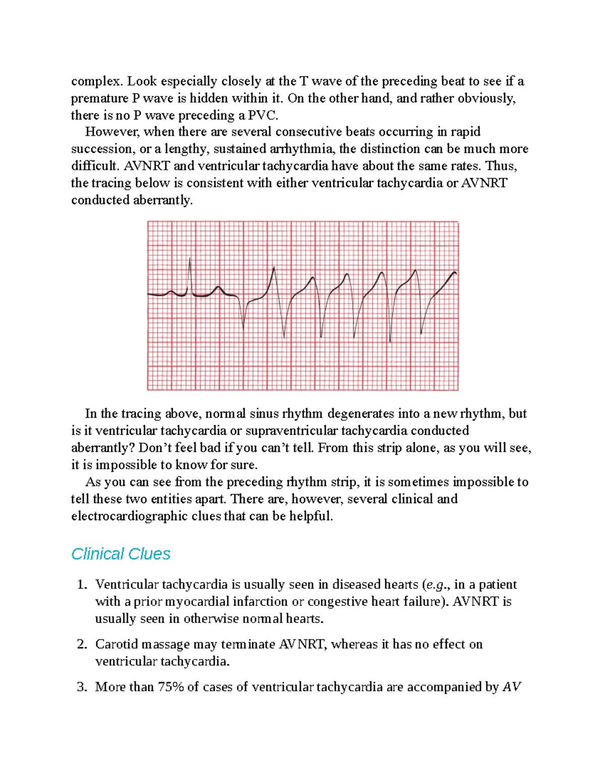 The only EKG-57 - The only EKG - complex. Look especially closely at ...