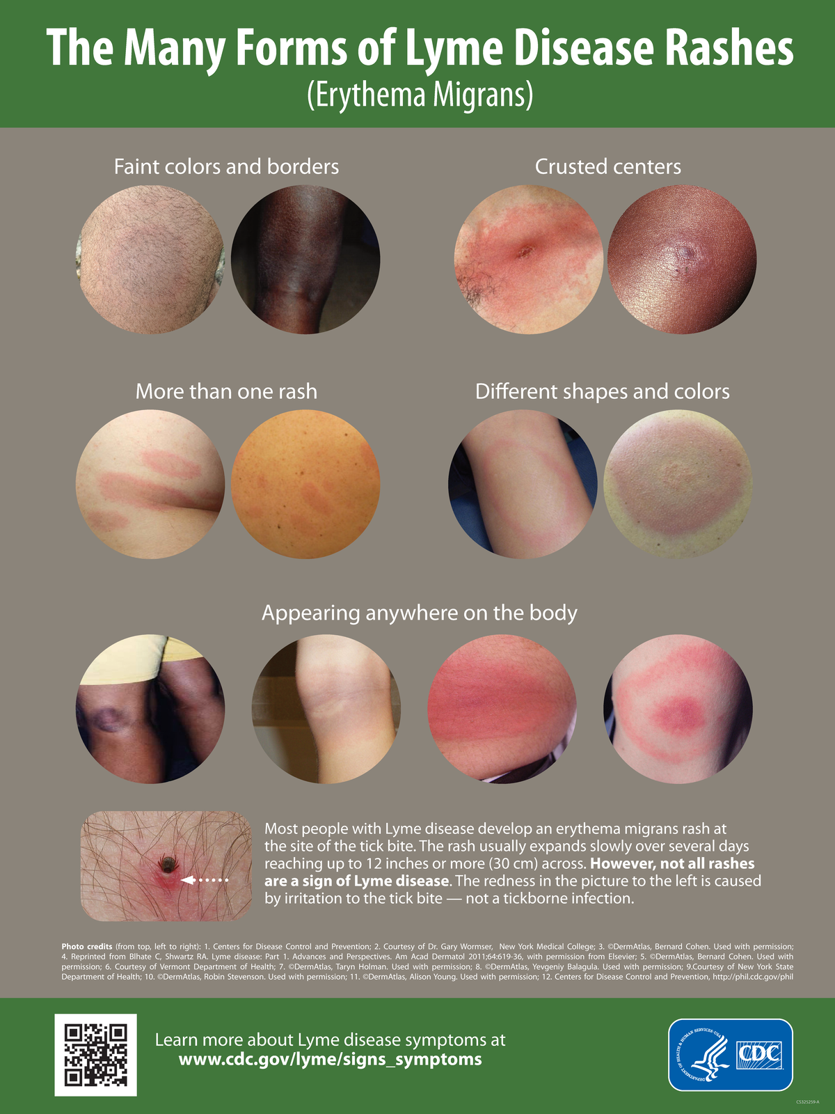 CDC - Lyme Disease Rash Poster - The Many Forms of Lyme Disease Rashes (Erythema Migrans) More ...