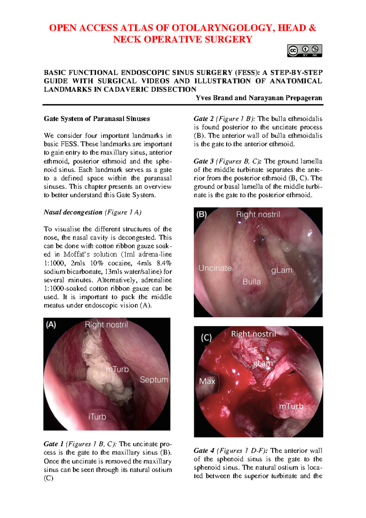 Basic FESS - Step-by-step guide with surgical videos - OPEN ACCESS ...