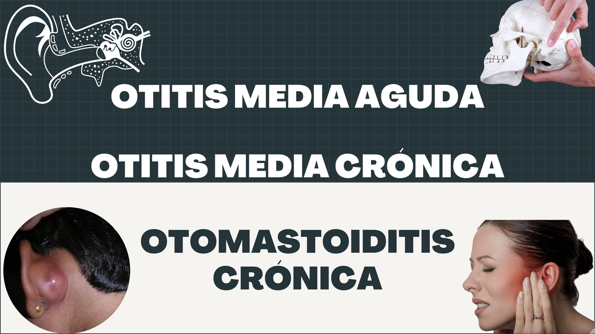 Otitis y otomastoiditis - OTITIS MEDIA AGUDA OTOMASTOIDITIS CRÓNICA ...