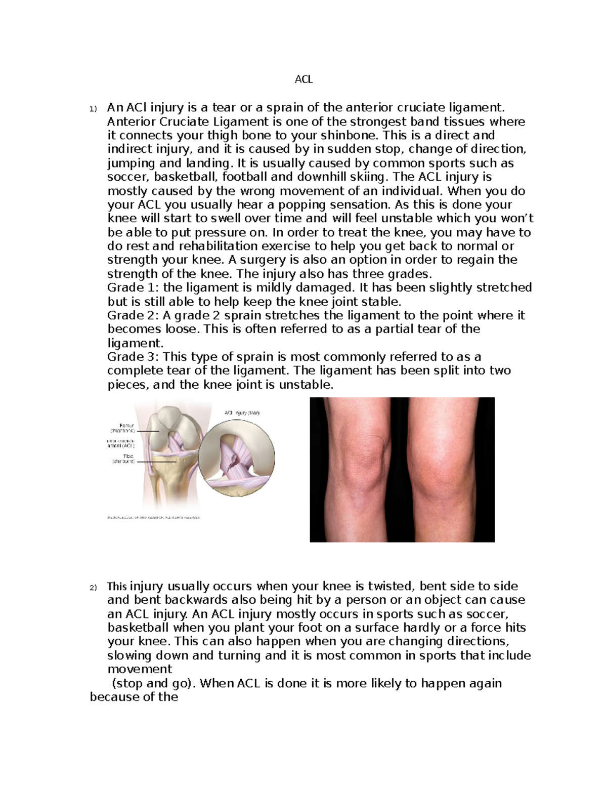 ACL - idk - ACL An ACl injury is a tear or a sprain of the anterior ...