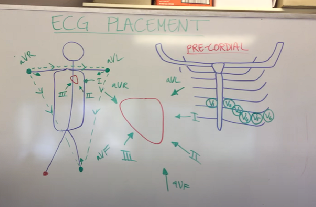 ECG Placement and leads - Mechanismen gezondheid en ziekte, Beweging en ...