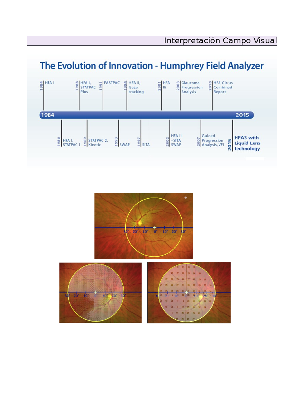 Interpretación Campo Visual - Interpretación Campo Visual ÍNDICES GLOBALES DM DSM FC GRÁFICA ...