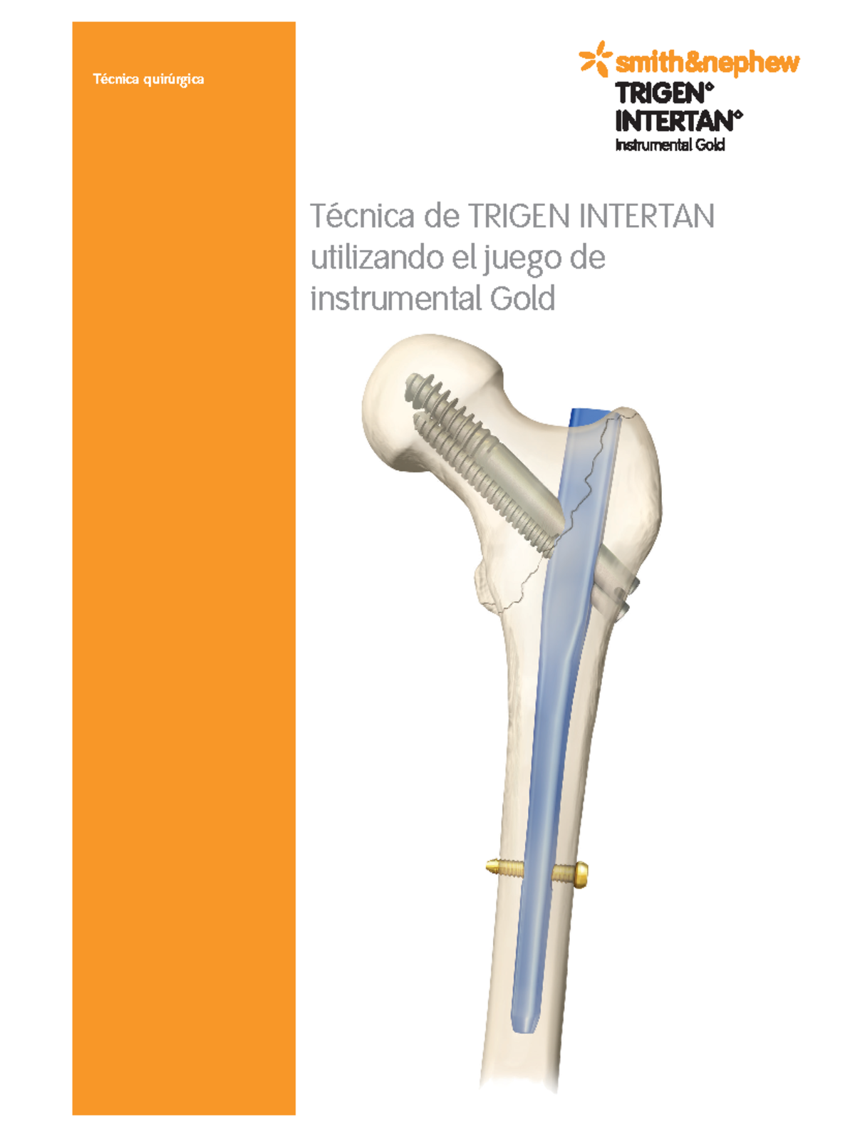 Intertan gold st es 01120-esv1 - Técnica quirúrgica Técnica de TRIGEN ...