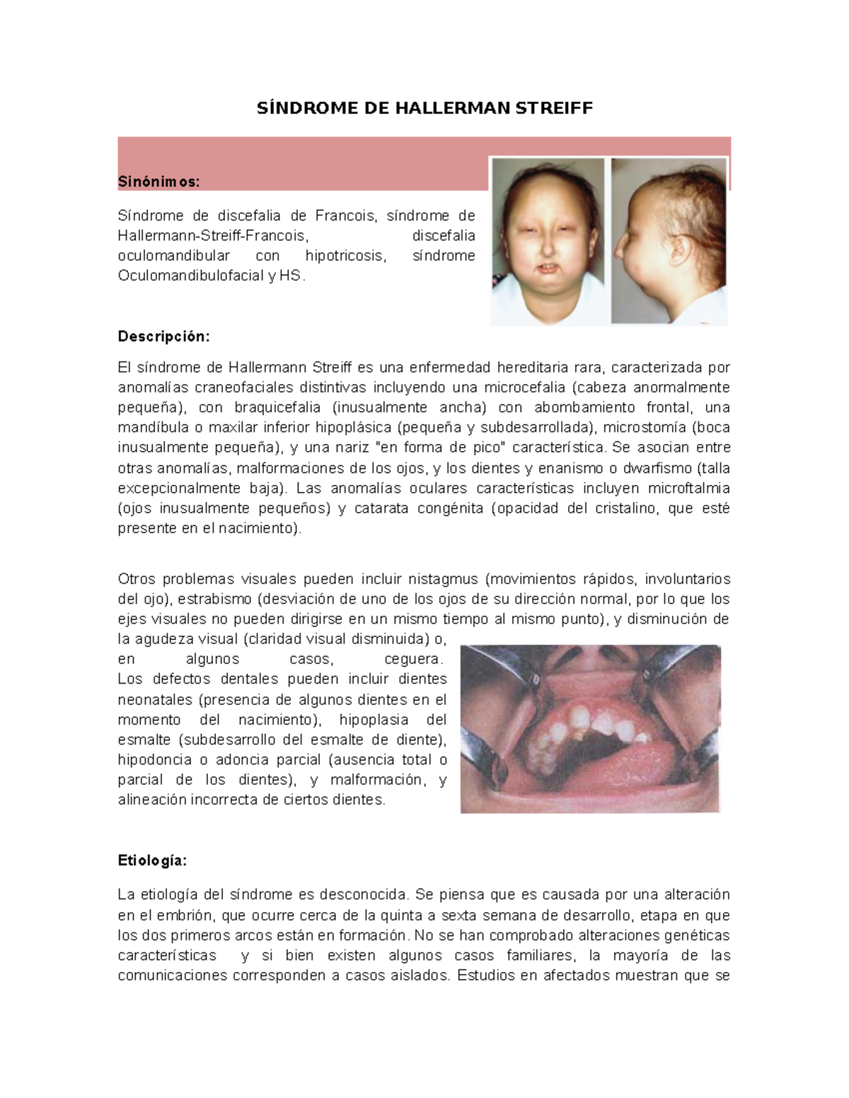 Sindrome DE Hallerman Streiff - SÍNDROME DE HALLERMAN STREIFF Sinónimos ...