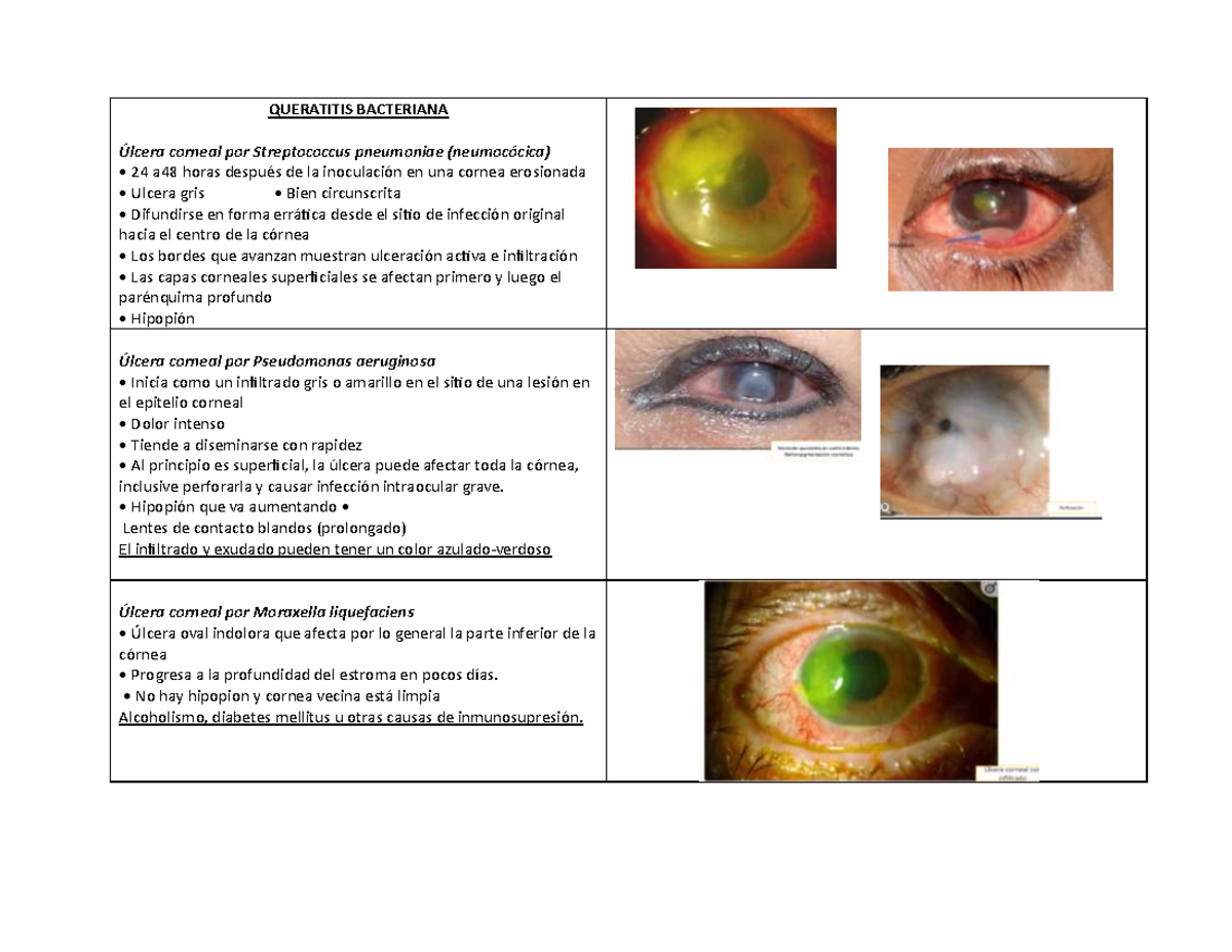 Queratitis Bacteriana - QUERATITIS BACTERIANA Úlcera corneal por ...