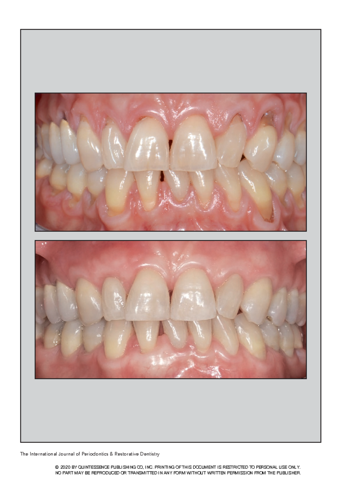 Article - Periodontal illnes - The International Journal of ...