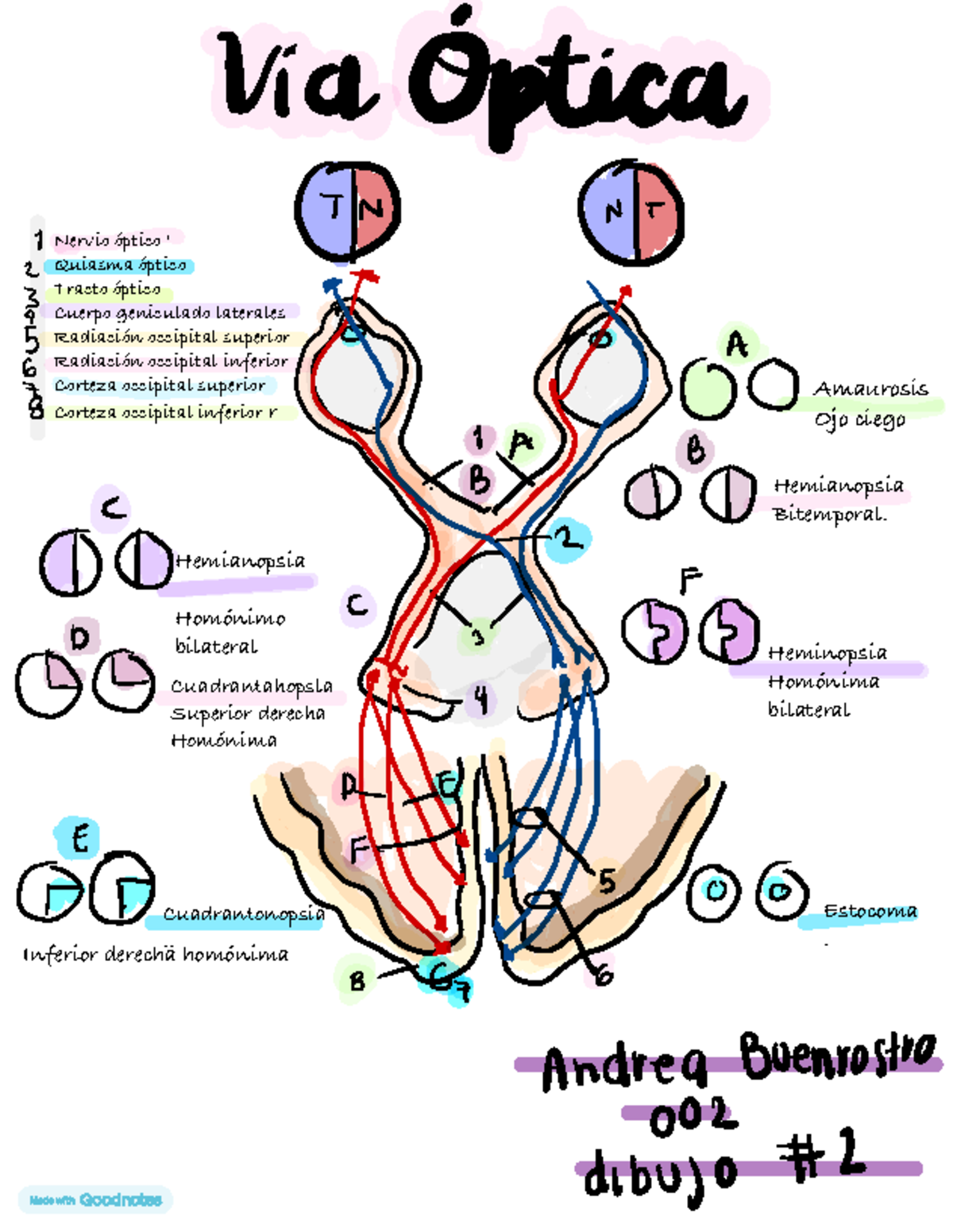 Vía óptica dibujo Andrea - Cuadrantonopsia .. Inferior derecha homónima ...