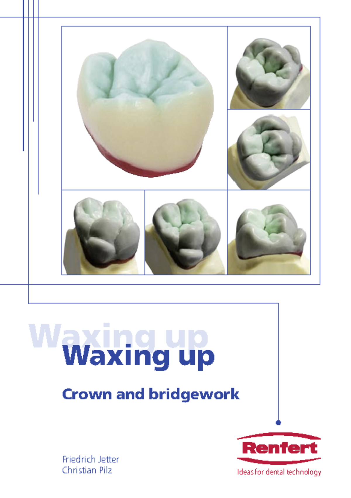 Waxing - ####### Ideas for dental technology Waxing up Waxing up Crown ...