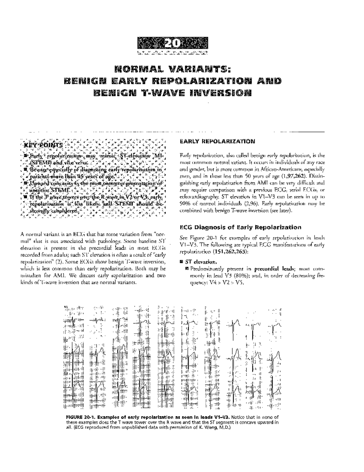 4 ECG in Acute MI - IAM - 20 NORMAL VARIANTS: BENIGN EARLY ...