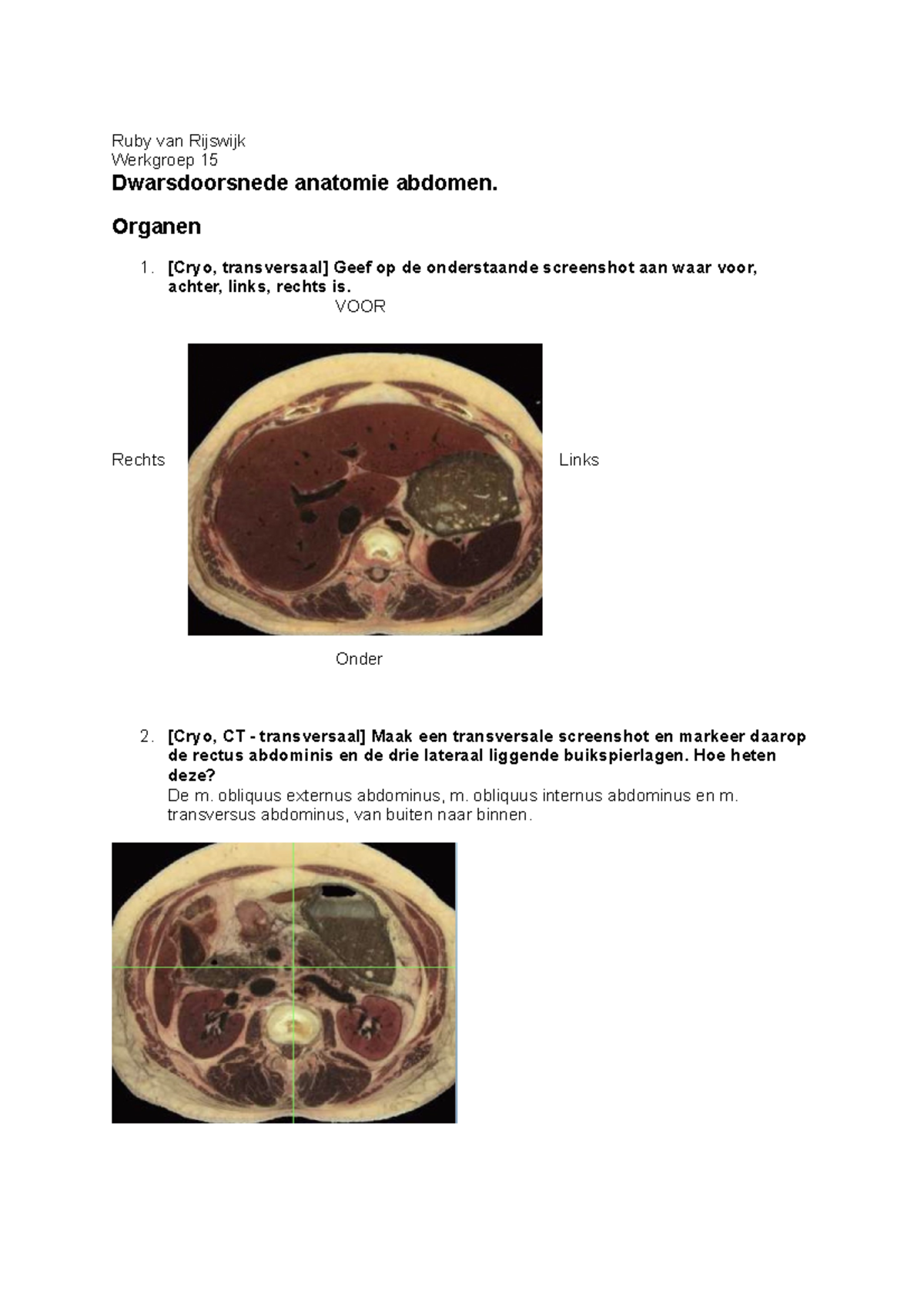 Dwarsdoorsnede anatomie abdomen - Organen [Cryo, transversaal] Geef op ...