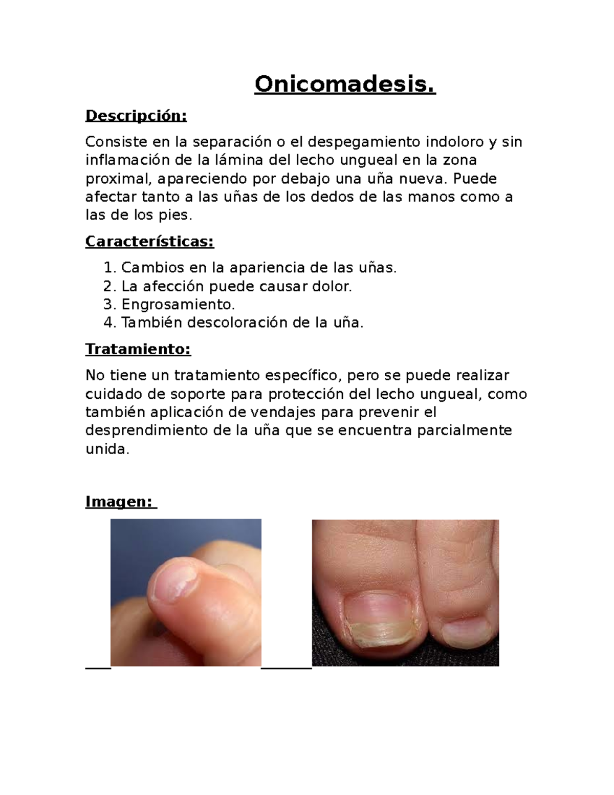 Onicomadesis - enfermedades en las uñas - Onicomadesis. Descripción ...